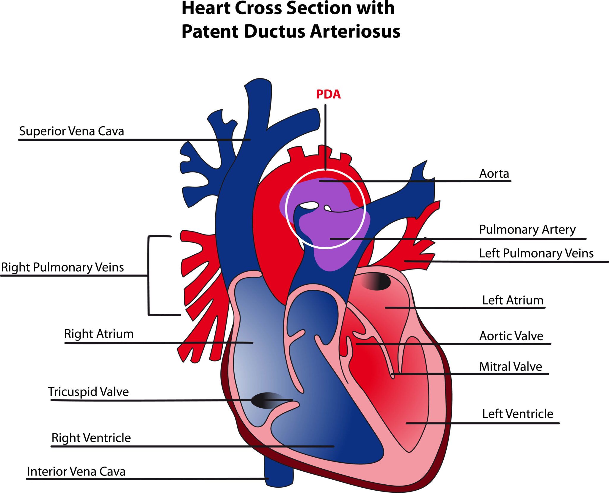 Cardiac Lyme Disease Signs and Symptoms